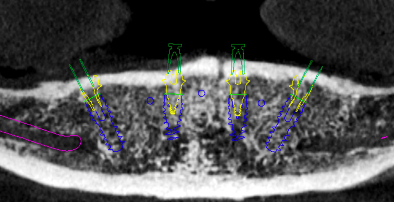 Full Arch Solutions from FP3 to FP1 using Freehand and Digital ...