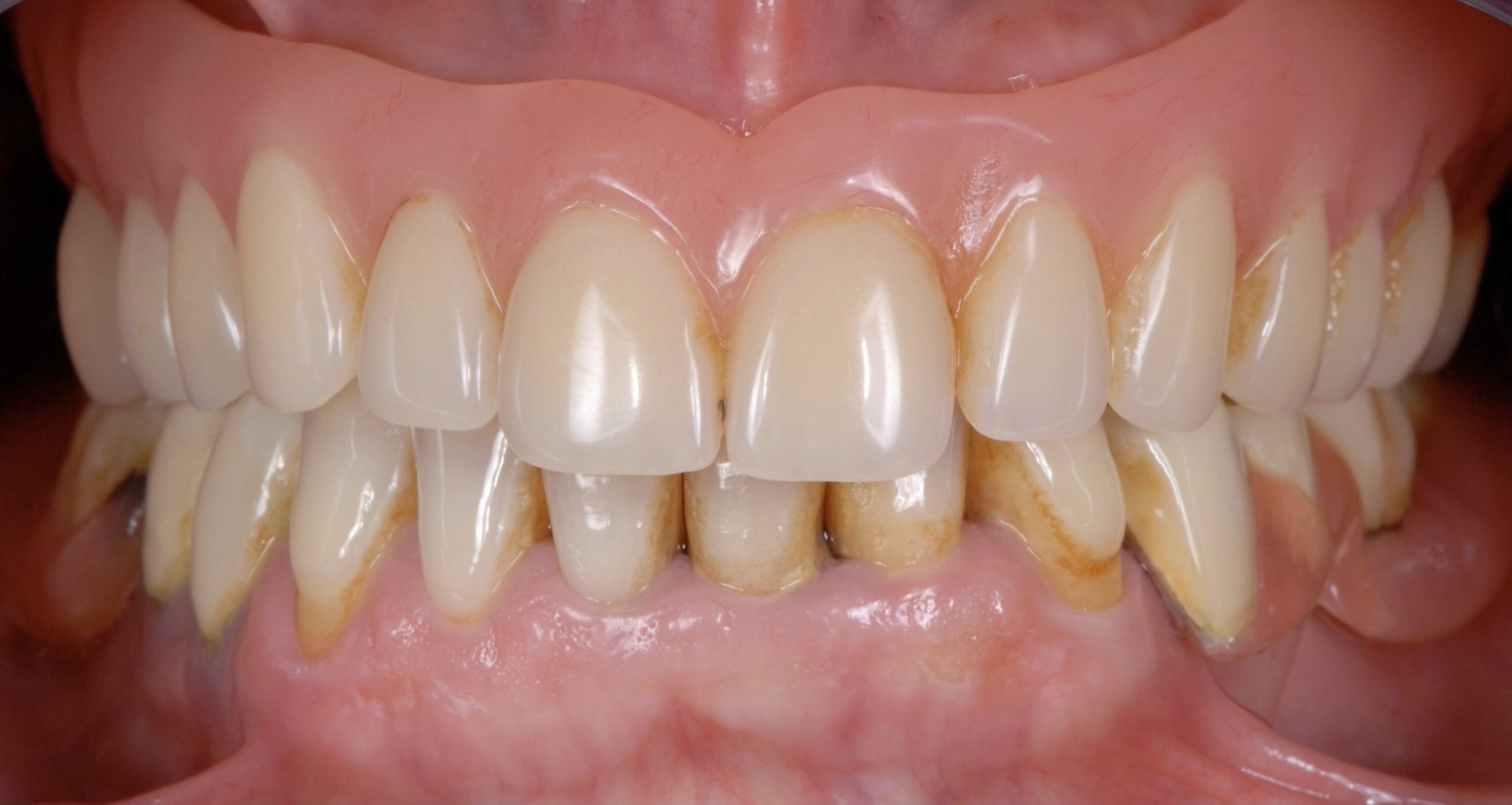 new_full_arch_case1_2025 - 2-day Full Arch and Single Tooth Live ...